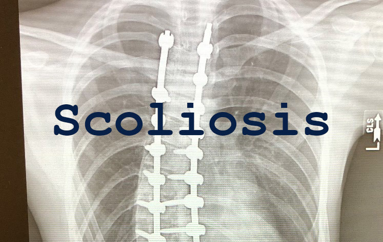 What is Scoliosis? | TOA